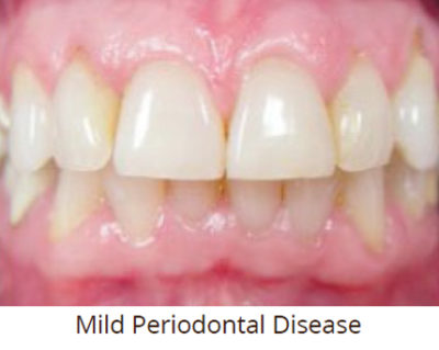 Periodontitis Treatment Mokena, Illinois | Specialized Gum Disease ...
